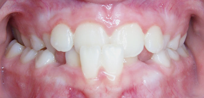 What Causes Cross Bite and TMJ | Zaytoun Orthodontics