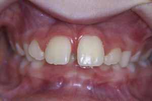 Protruding Teeth | Zaytoun Orthodontics