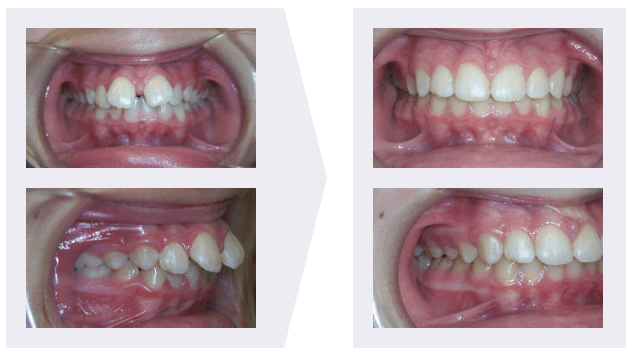 Protruding Teeth | Zaytoun Orthodontics | Cary Garner Raleigh