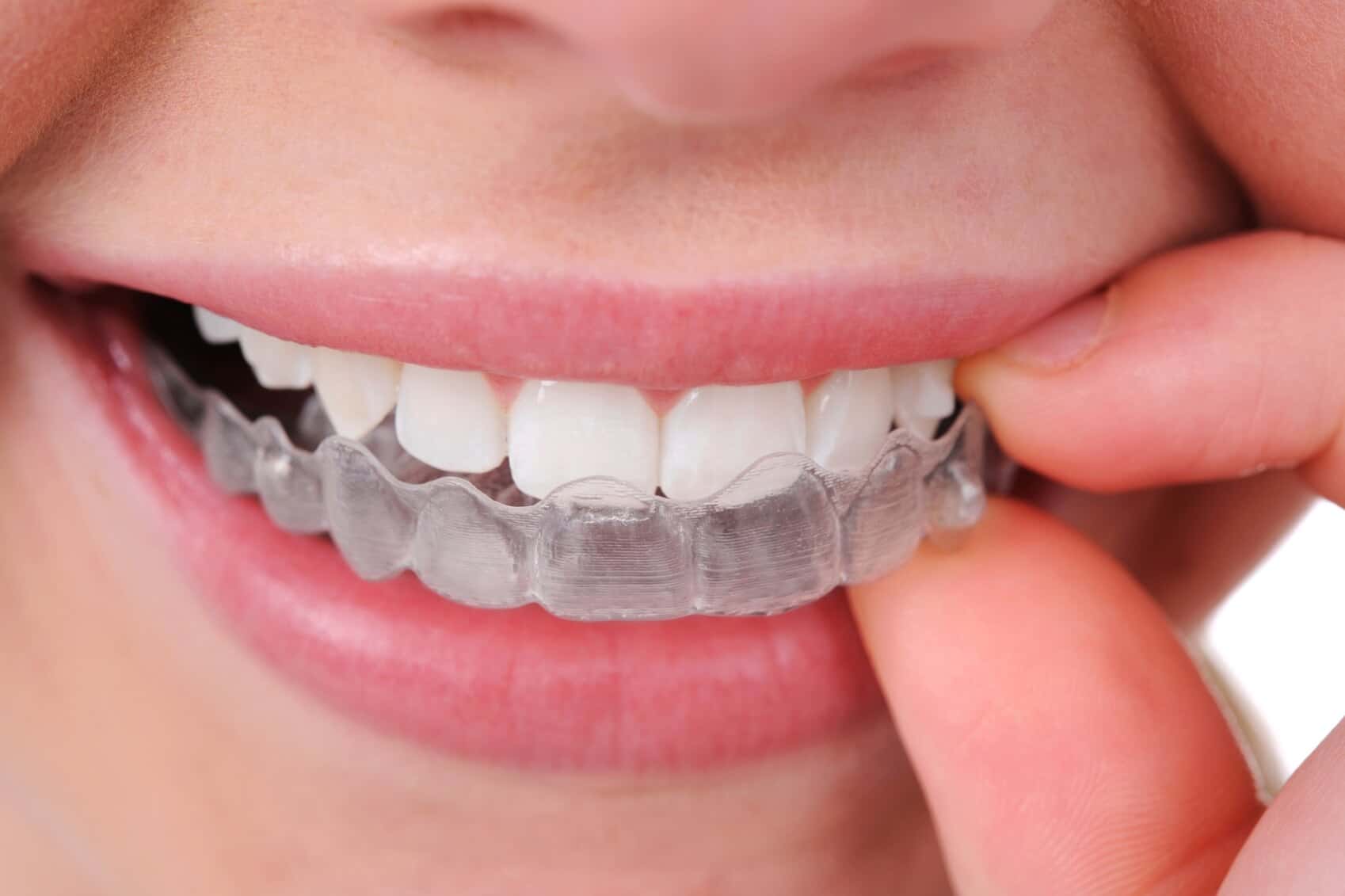 Invisalign FAQ | Zaytoun Orthodontics | Cary Garner Raleigh