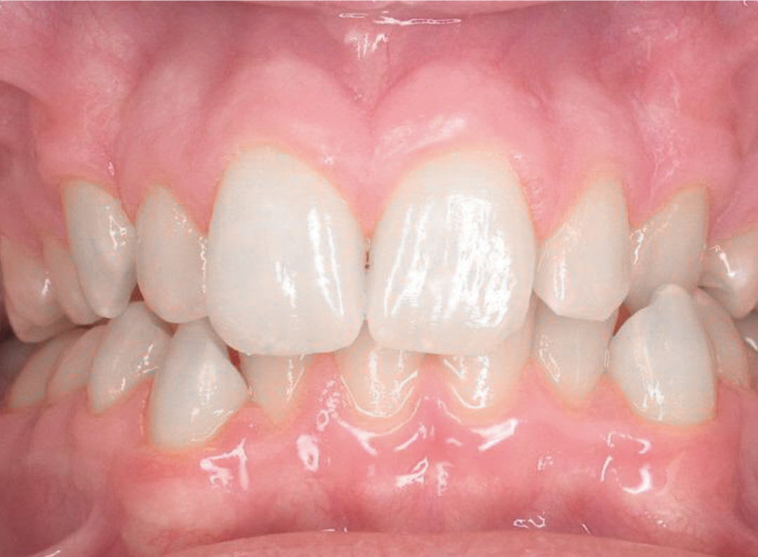 Smile Gallery - Zaytoun Orthodontics